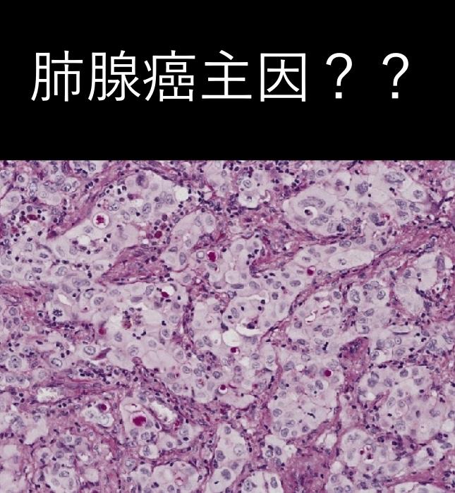 The Enigma Surrounding The Causes Of Lung Adenocarcinoma Unraveling